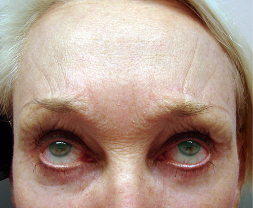 Photo Gallery - Botox Case 1 | Dr. Vivian Hernandez