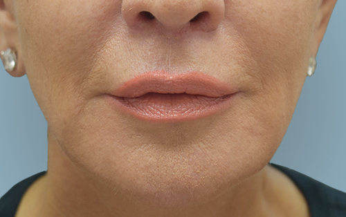 Photo Gallery - Lip Lift Case 1 | Dr. Vivian Hernandez